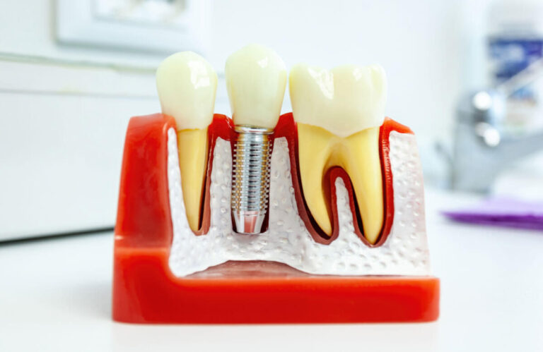 Dental Implants: Permanent Tooth Replacement in Philadelphia